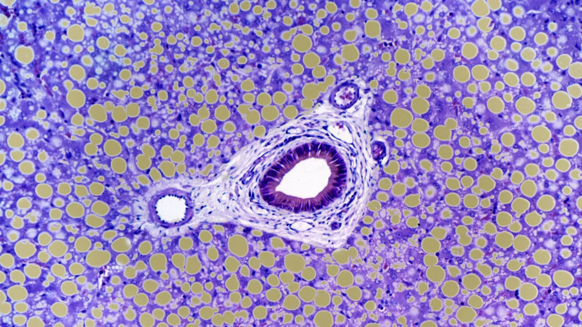 Hépatite alcoolique : E. faecalis responsable | Contenus pour les ...