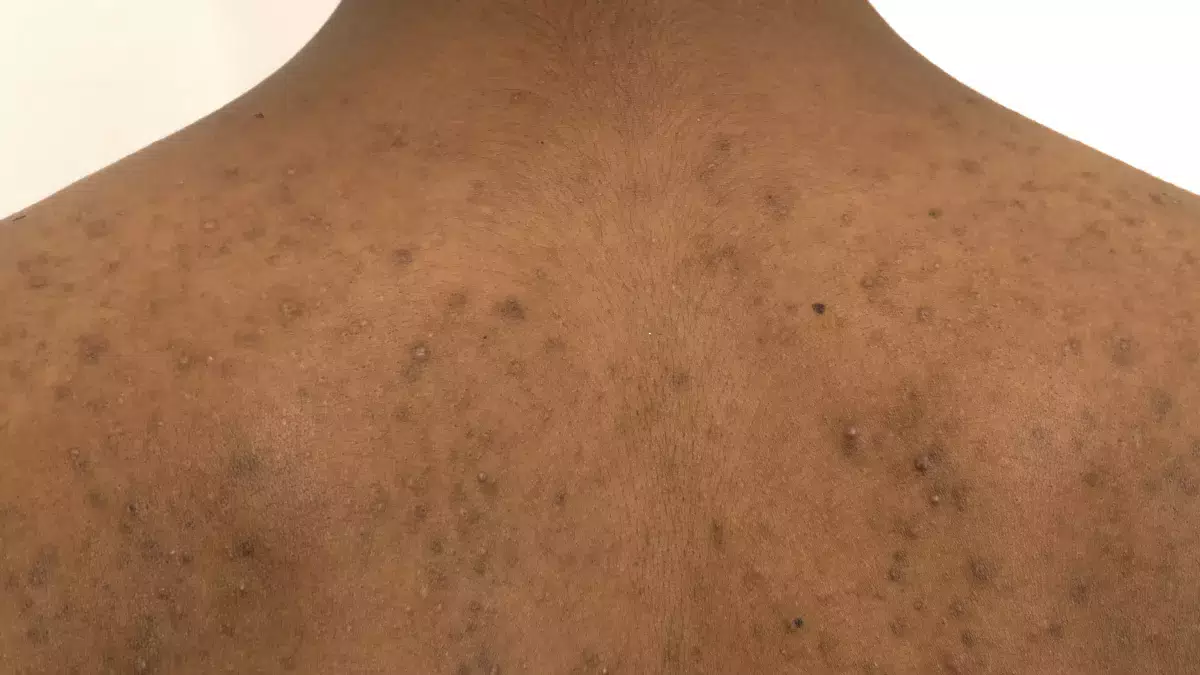 Antibiotics, a double-edged sword when managing skin disease | Content ...