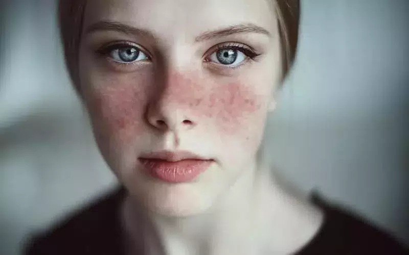 Ruminococcus gnavus , le grand méchant loup du lupus ? | Contenus pour ...